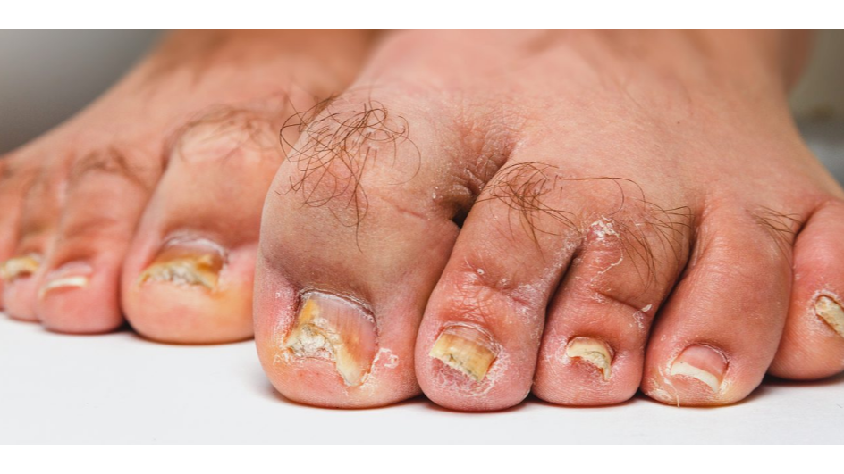 How Toe Fungus Starts: Causes and Prevention Tips - CENTRAL - NEWS ...